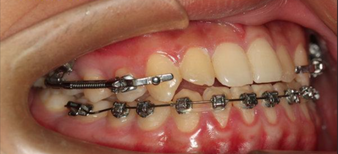 Lingual And Buccal Molar Distalization Appliance In Orthodontics ...